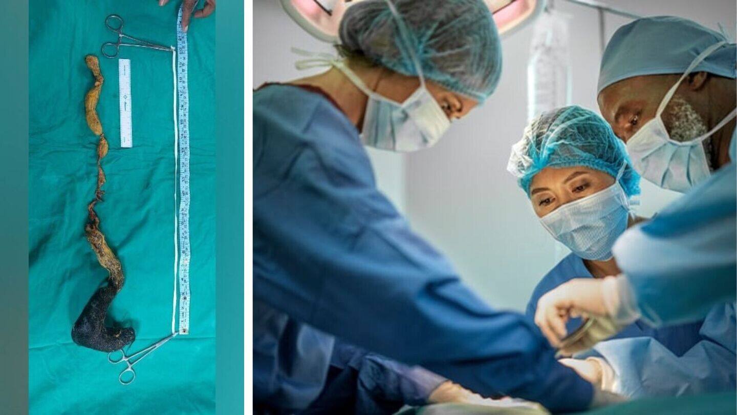 10-year-old girl has half-kilo hairball removed from her stomach
