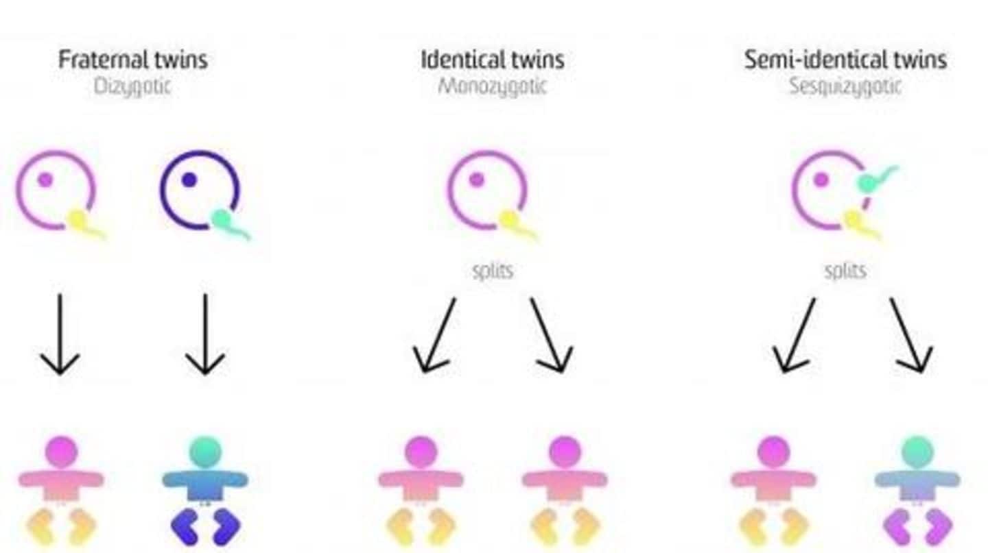 Australia: Second case of semi-identical twins, a rare phenomenon ...