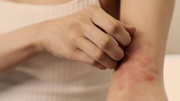 Dealing with skin rashes is easy with these home remedies