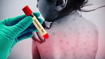 Chickenpox: Meaning, causes, symptoms, and treatment