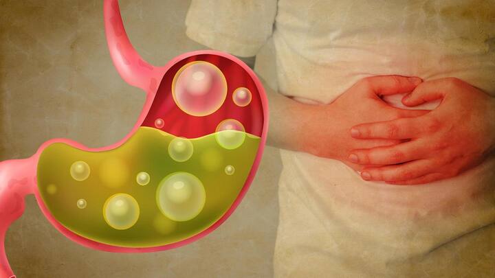 Acid reflux: Meaning, causes, symptoms, remedies, and treatment