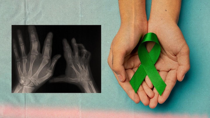 CLOVES Syndrome Awareness Day 2022: Types, symptoms and treatment